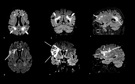 White Matter Hyperintensity and Vascular Disease from Biological Basis to Clinical Significance